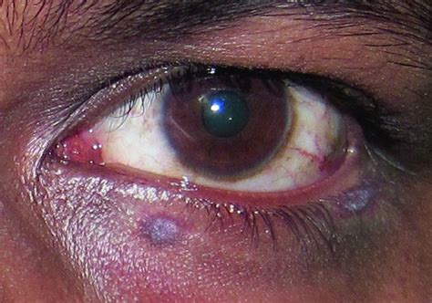 Imagekaposi Sarcoma Early Stage Msd Manual Professional Edition