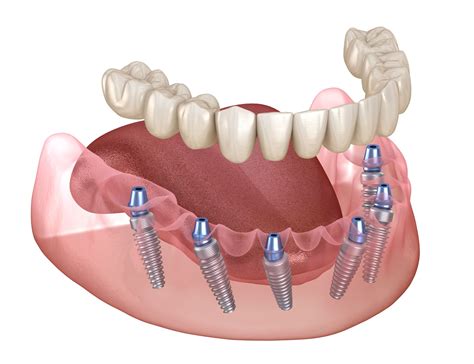 Understanding The All On 4 Procedure Step By Step Breakdown