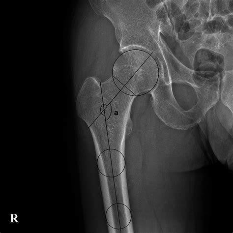 Simple Minimally Invasive Method To Reduce Valgus‐impacted And Tilted