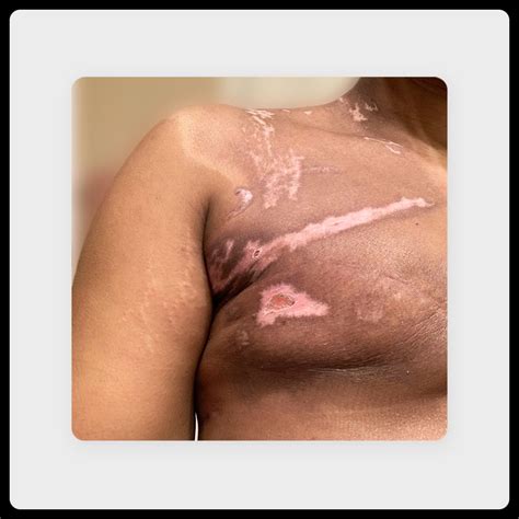 What It Looks Like Single Mastectomy With Flat Closure