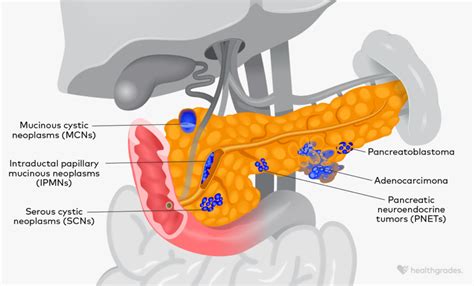 Types Of Pancreatic Cancer Symptoms Treatment And More