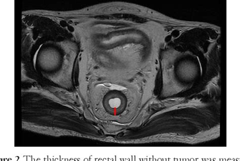 Figure 2 From Quantitative Ct Measurement Of Left Colonic And Pelvic