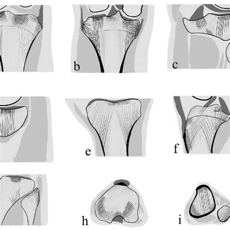 Sagittal Section Of The Proximal Tibia Through The Central Part Of The Download Scientific