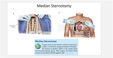 Median Sternotomy Diagram Quizlet