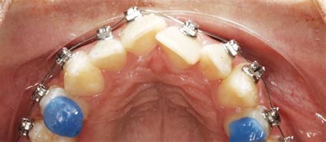 A Voice In The Arena Bite Ramps Part 1 Class 2 Bite Ramps By Dr