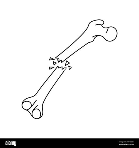 Greenstick Bone Fracture Stock Vector Images Alamy