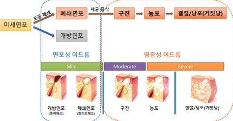 여드름 2편 여드름의 단계유형별 특징 미모드림의원