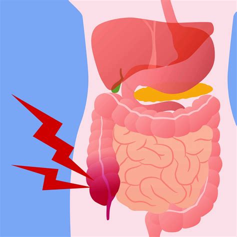 Acute Appendicitis Symptoms And Treatment Nexus Surgical