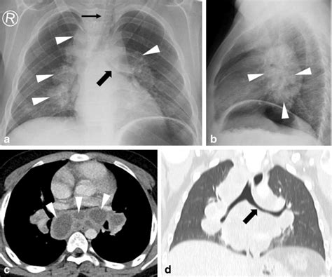 小儿结核病的影像学建议和算法：第 1 部分——胸部结核pediatric Radiology X Mol