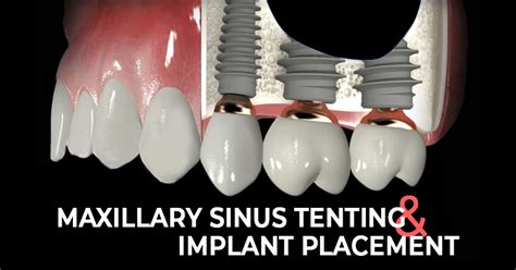 Maxillary Sinus Bone