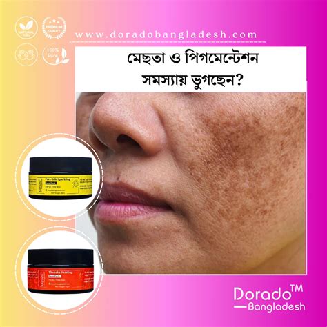 Melasma And Pigmentation Solution Dorado Bangladesh