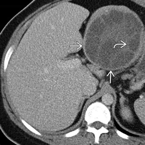 Hepatic Hydatid Cyst Radiology Key