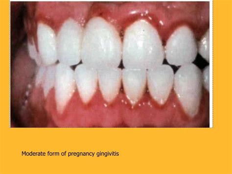 Ppt Pregnancy Gingivitis Powerpoint Presentation Free Download Id