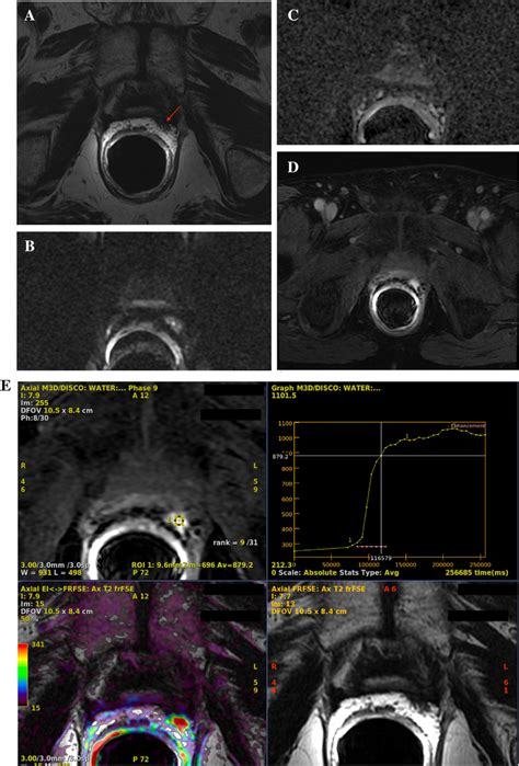 A 65 Year Old Man Who Presented Two Consecutive Serum Psa Levels Above Download Scientific