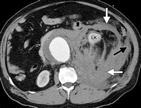 Peritoneal And Retroperitoneal Anatomy And Its Relevance For Cross Sectional Imaging Radiographics