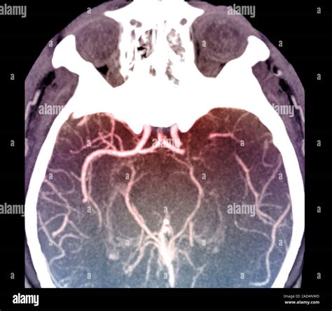 Brain In Stroke Coloured Computed Tomography Ct Scan Of An Axial Section Through The Brain Of