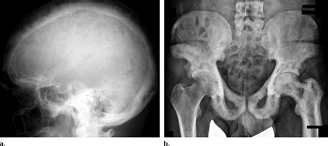 Blastic Phase Of Paget Disease A Lateral Radiograph Of The Skull Download Scientific Diagram