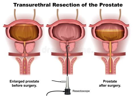 Transurethral Resection 3d Illustration Medical Vector Infographic With