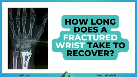 Broken Wrist Recovery And Healing Time