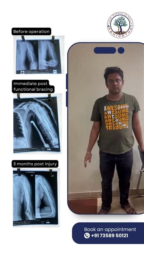 Comminuted Humerus Fracture Managed Conservatively Happy Patient Happy Surgeon [video] Surgeon