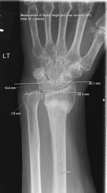 Radius Fracture