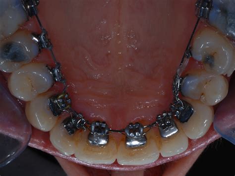 Can You Get Braces On The Back Of Your Teeth At Victoria Sanchez Blog