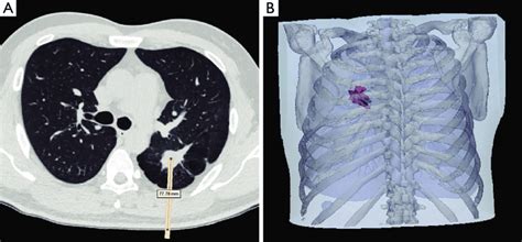 Insertion Route Design And Reconstruction Of The CT Images The Download Scientific Diagram
