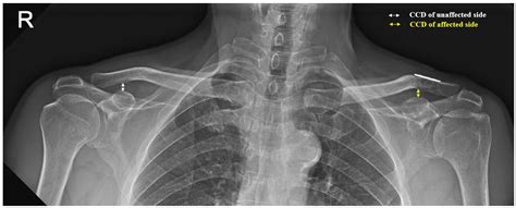 Progressive Loss Of Acromioclavicular Joint Reduction Correlated With
