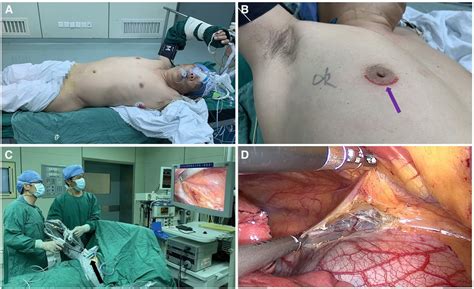 Frontiers Transareolar Uniportal Thoracoscopic Extended Thymectomy For Patients With
