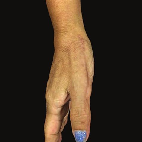 View Of Giant Cell Tumor Of Thumb Metacarpal Preoperatively Download