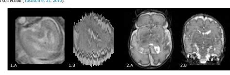 Figure 1 From A Review On Automatic Fetal And Neonatal Brain Mri Segmentation Semantic Scholar