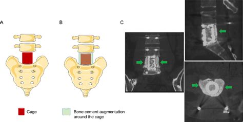 Diagram Showing Bone Cement Augmentation Around The Expandable Titanium Download Scientific