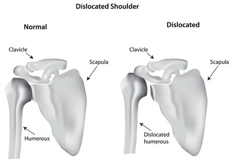 Shoulder Dislocation Causes Symptoms Treatment And Braces
