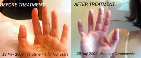 Carotenemia Skin