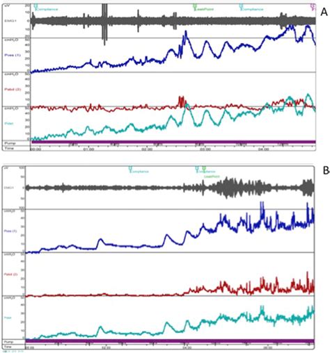 A Cystometry Curve Depicting Detrusor Overactivity With High Pressure