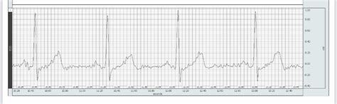Solved Calculate Heart Rate For Both Images And Explain How Chegg Com
