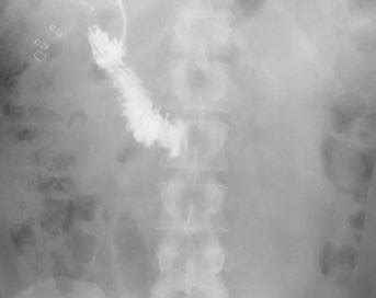 Anteroposterior View During Initial Phase Of T Tube Cholangiogram Download Scientific Diagram