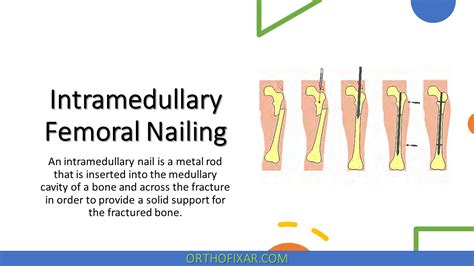 Intramedullary Femoral Nailing Easily Step By Step OrthoFixar