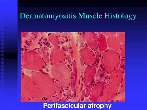Dermatomyositis Histology