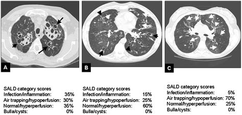 Lung Abnormalities On Ct Scan Computed Tomography Ct Scans And