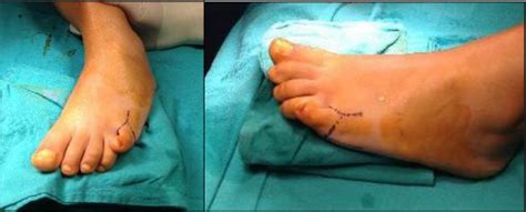 Treatment Of The Overriding Fifth Toe Butlers Arthroplasty Is A Good