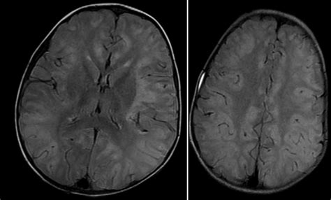 Brain Mri In Flair Sequence Shows Extensive Symmetric And Bilateral Download Scientific