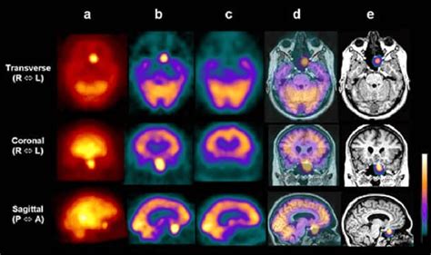 Left Sphenoid Sinus Bleeding During Generalized Tonicclonic Seizure