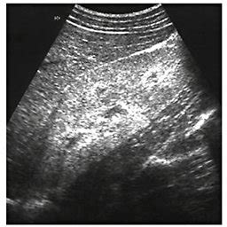 End Stage Renal Disease With Marked Reduction In The Corticomedullary