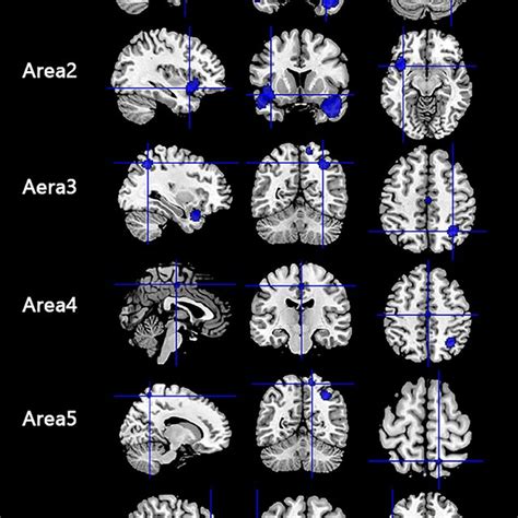Regions Of Gray Matter Increase In Patients With Idiopathic Dystonia