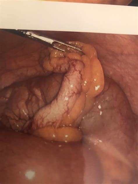 How Does My Appendix Look R Surgery