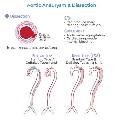 Clinical Pathology Glossary Aortic Aneurysm And Dissection Ditki Medical And Biological Sciences