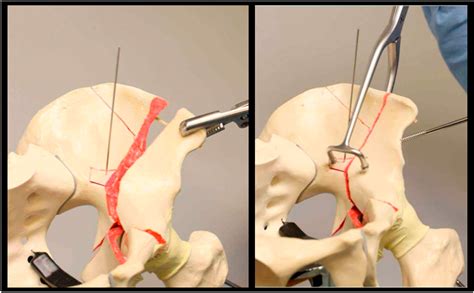 Associated Both Column Acetabular Fracture An Overview Of Operative Steps And Surgical