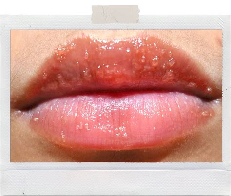 Как выглядит герпес на губе внутри фото