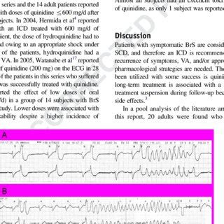 Ventricular Ectopy And A Salvo Of Polymorphic Ventricular Tachycardia Download Scientific Diagram